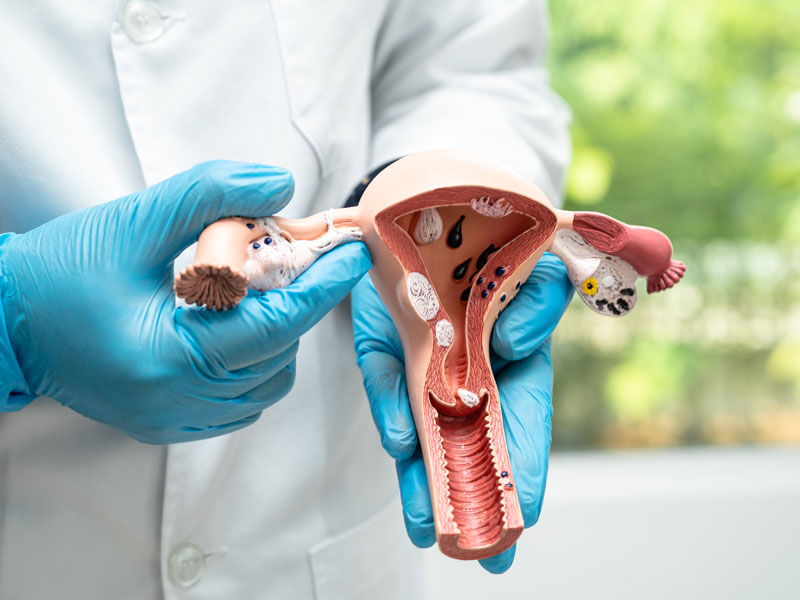 PCOS vs. Endometriosis – Key Differences and Impact on Fertility ...